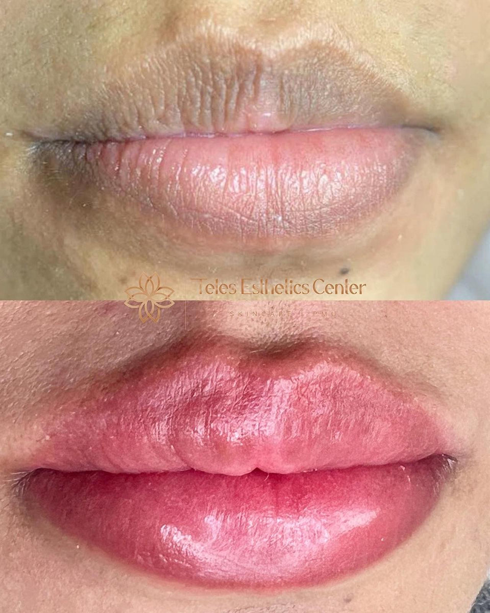 Lip neutralization/ Magic rainbow technique – Teles Esthetics Center